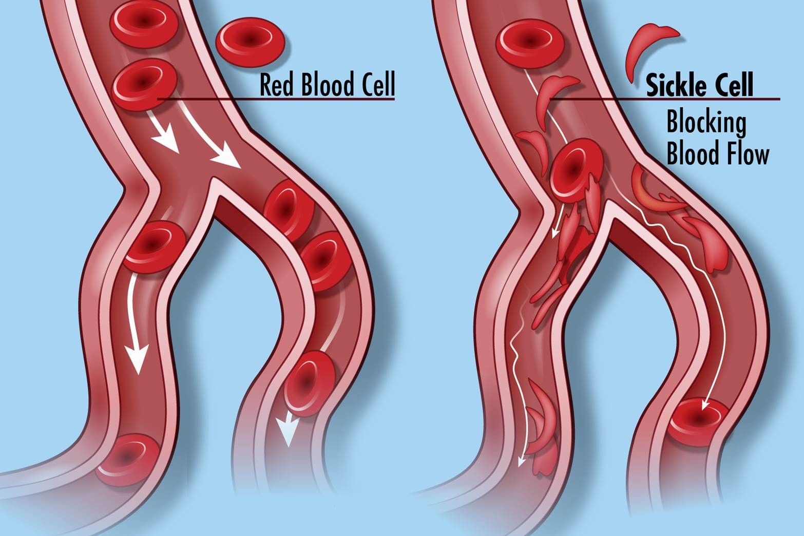 UCT Professor s Research Offers Hope Of Treatment For Sickle Cell 